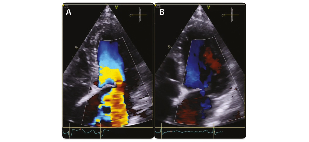 Traitement de l’insuffisance mitrale sévère par stimulation de l’aire ...